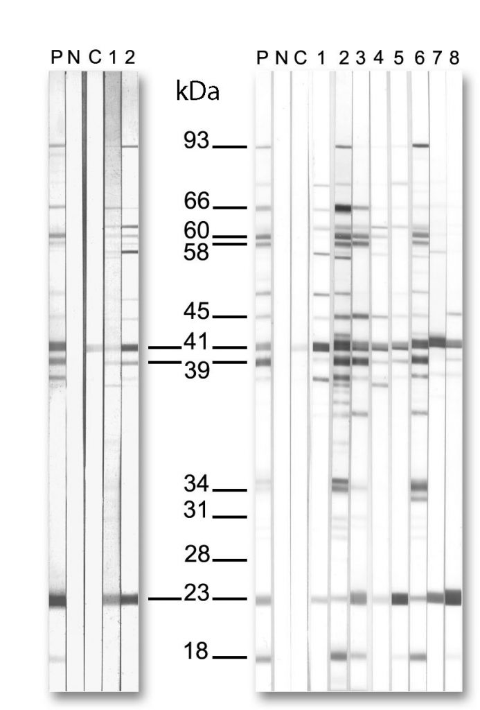 CDC scientist: Why bands 31 and 34 aren’t used in Lyme disease testing