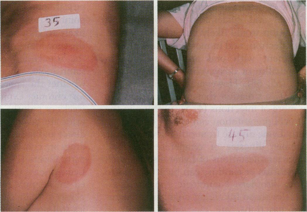 The Biological and Social Phenomenon of Lyme Disease: 1993 review